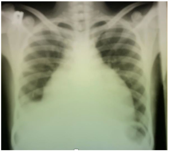 IJERPH | Free Full-Text | Subacute Cardiac Tamponade Due to Tuberculous ...