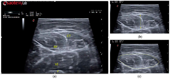 Musculoskeletal Ultrasound Shows Muscle Mass Changes during Post-Acute ...