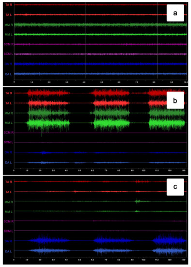 The Difference in Electromyographic Activity While Wearing a Medical ...