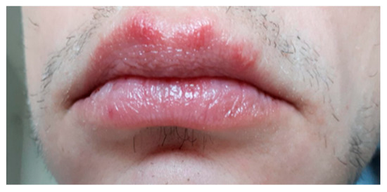 Clinical and Pathological Manifestation of the Oral Mucosa in ...