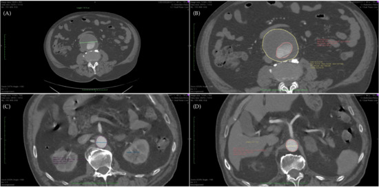 Computed Tomography Angiography Markers and Intraluminal Thrombus ...