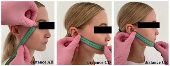 Recovery following Orthognathic Surgery Procedures—A Pilot Study