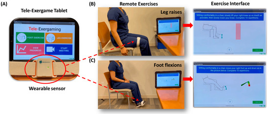 Tele-Medicine Based and Self-Administered Interactive Exercise Program (Tele-Exergame) to ...