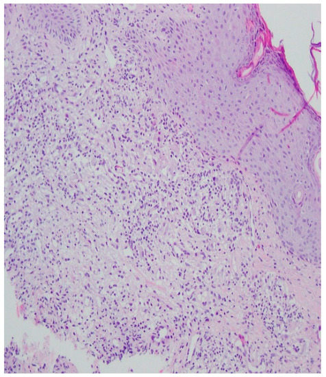 Challenges in the Diagnosis of Tertiary Syphilis: Case Report with ...
