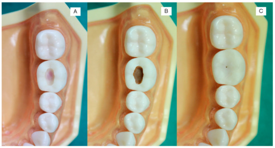 Assessment of 3D-Printed Tooth Containing Simulated Deep Caries Lesions ...