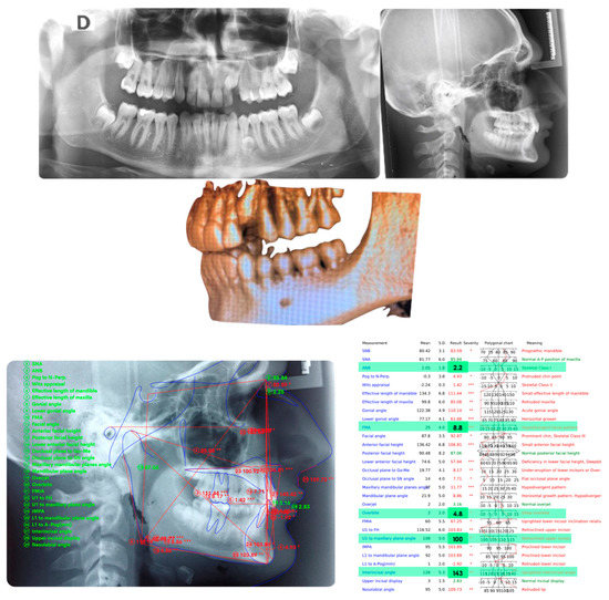 Impacted Canine Management Using Aligners Supported by Orthodontic ...