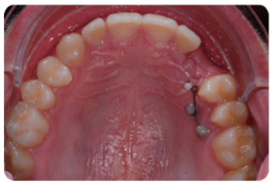 Impacted Canine Management Using Aligners Supported by Orthodontic ...