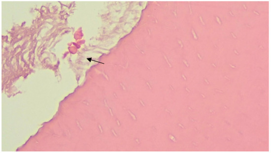 Morphological Characteristics and Prevention of Tooth Enamel ...