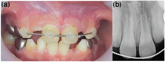 Flapless Decoronation: A Minimally Invasive Approach