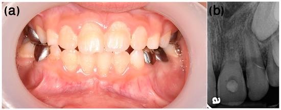 Flapless Decoronation: A Minimally Invasive Approach