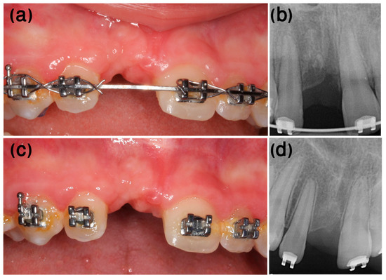 Flapless Decoronation: A Minimally Invasive Approach