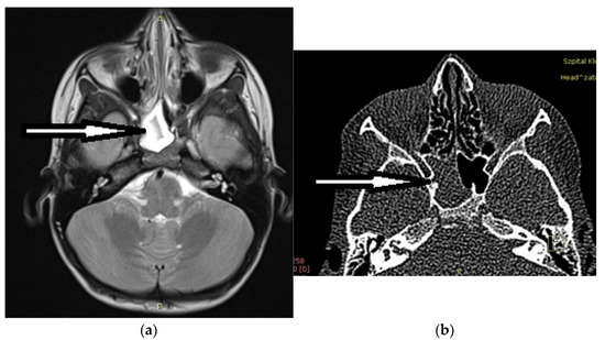 Isolated Sphenoid Sinus Disease in Children