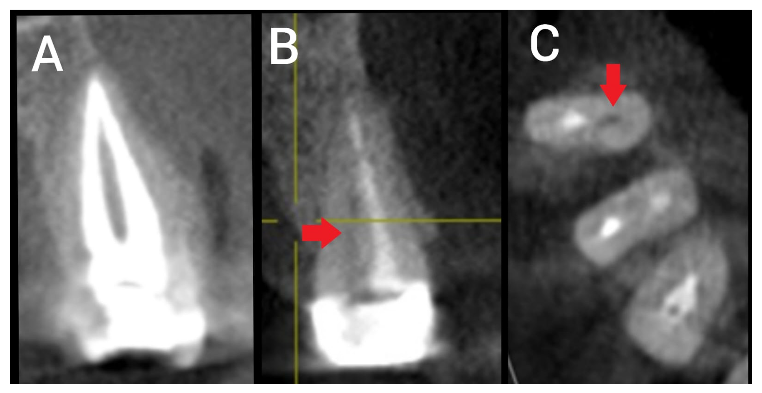 Ijerph Free Full Text Root Canal Configuration And Its Relationship
