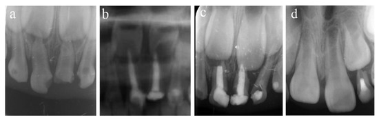 Survival Analysis and Risk Factors of Pulpectomy among Children with ...