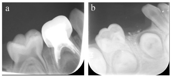 Survival Analysis and Risk Factors of Pulpectomy among Children with ...
