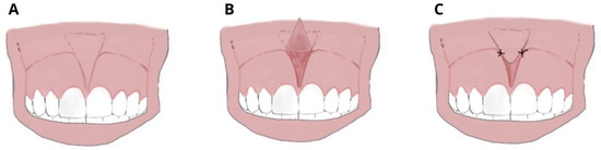 Laser Surgical Approach of Upper Labial Frenulum: A Systematic Review