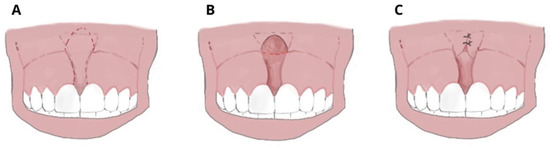 Laser Surgical Approach of Upper Labial Frenulum: A Systematic Review
