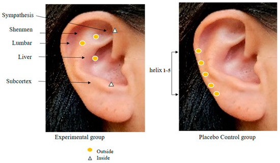 The Effects of Auricular Acupressure on Low Back Pain, Neuropathy and ...