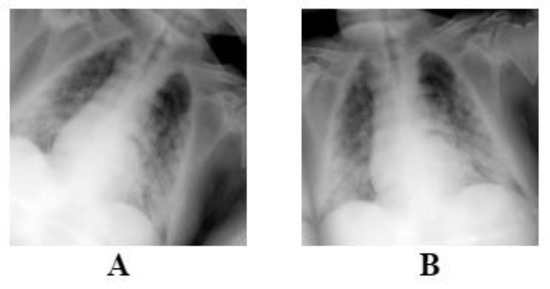 COVID-19 Classification on Chest X-ray Images Using Deep Learning Methods