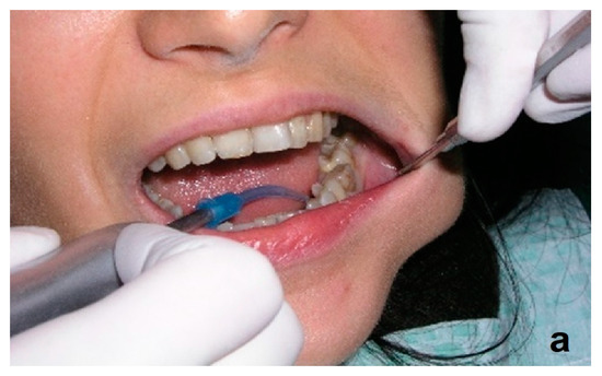 Potential Clinical Applications of Ozone Therapy in Dental Specialties ...