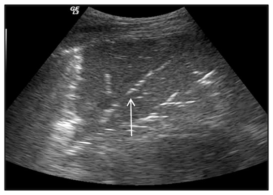 The Incremental Role of Multiorgan Point-of-Care Ultrasounds in the ...