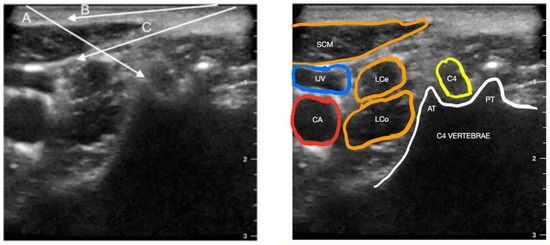 Ultrasound-Guided Blocks for Spine Surgery: Part 1—Cervix