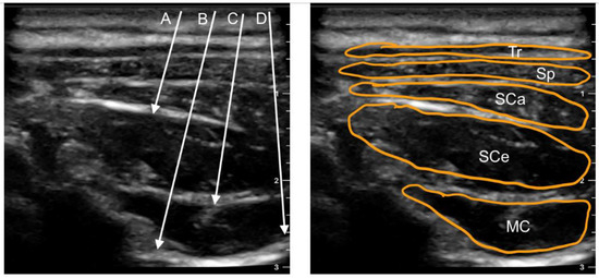 Ultrasound-Guided Blocks for Spine Surgery: Part 1—Cervix