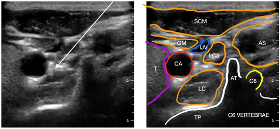 Ultrasound-Guided Blocks for Spine Surgery: Part 1—Cervix