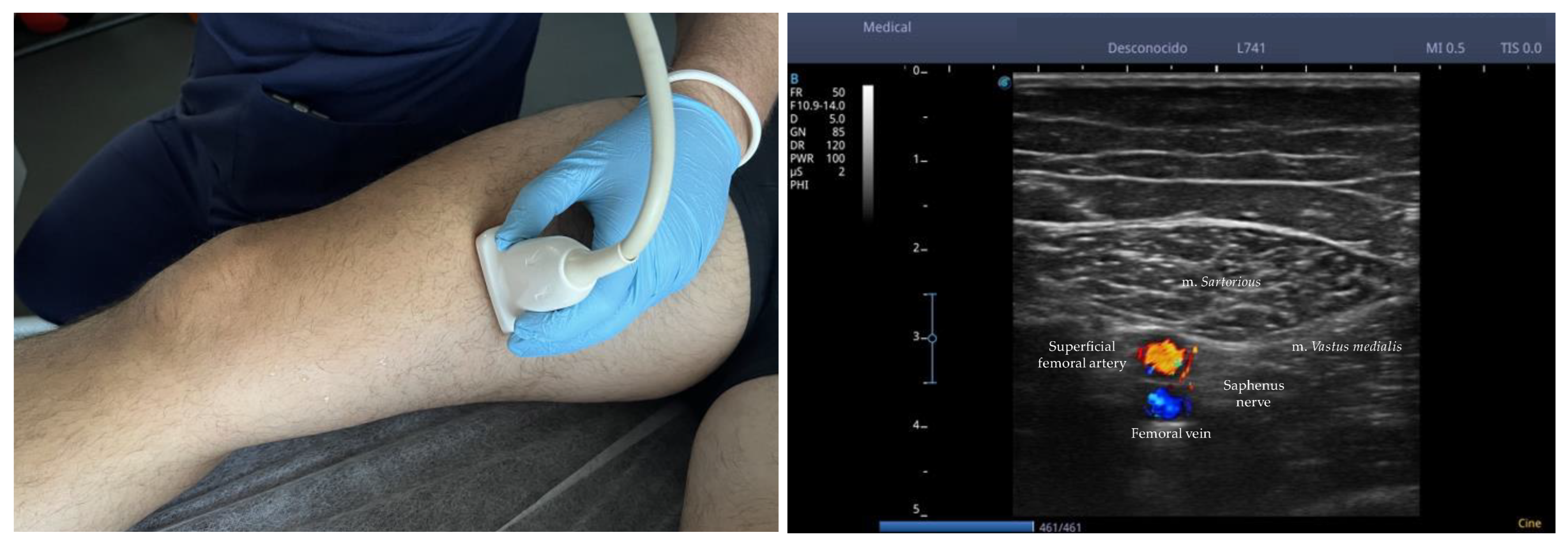 Percutaneous Electrical Nerve Stimulation (PENS) for Infrapatellar ...