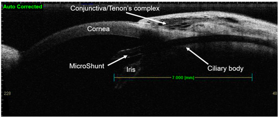 The PreserFlo MicroShunt in the Context of Minimally Invasive Glaucoma ...