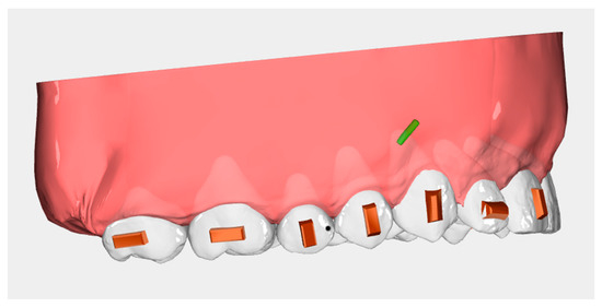 Predictability of Maxillary Molar Distalization and Derotation with ...
