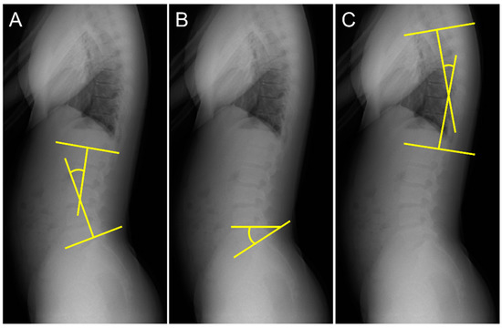 Spine Alignment in Standing and Maximal Upper Limb Elevation in ...