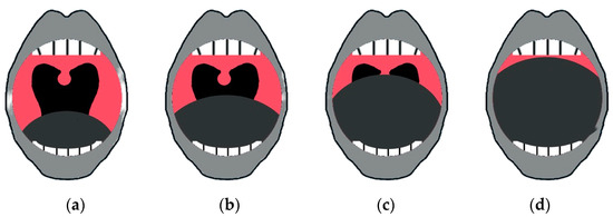 Friedman Tongue Position and the Anthropometric Parameters in Adult ...
