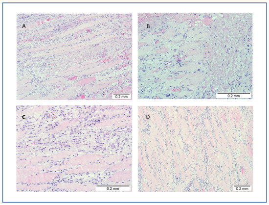 Diabetic Muscle Infarction—A Rare Diabetic Complication: Literature ...