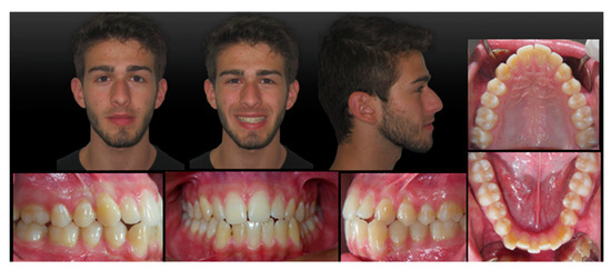 Clear Aligners Treatment of Class III Subdivision with an Extraction of ...