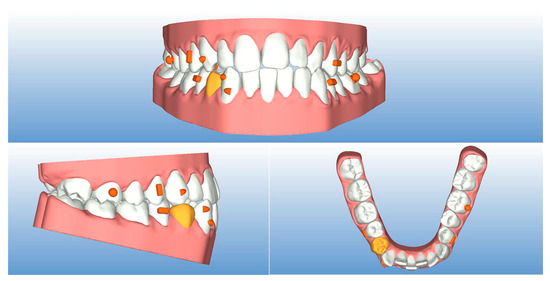 IJERPH | Free Full-Text | Clear Aligners Treatment of Class III ...