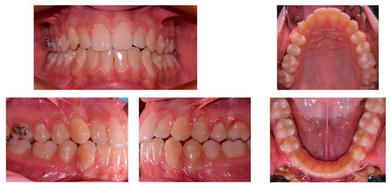 Clear Aligners Treatment of Class III Subdivision with an Extraction of ...