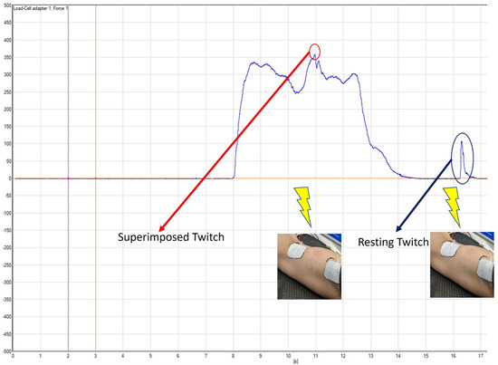 Effects of Unilateral Neuromuscular Electrical Stimulation with ...