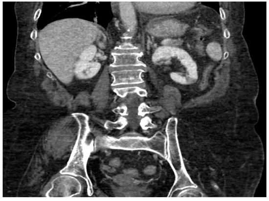 Lower Limb Ischemia as Acute Onset of Primary Aortic Occlusion: CTA ...