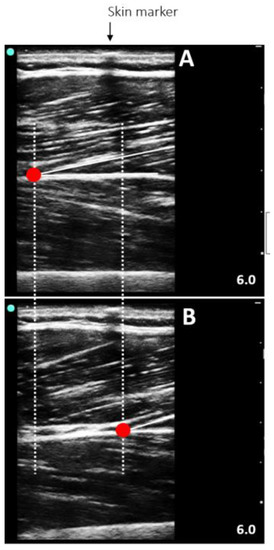 The Influence of Hip and Knee Joint Angles on Quadriceps Muscle-Tendon ...