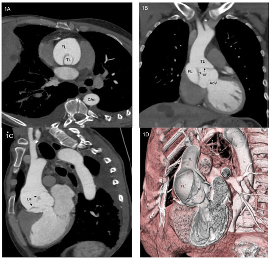 Endovascular Intervention for Aortic Dissection Is “Ascending”