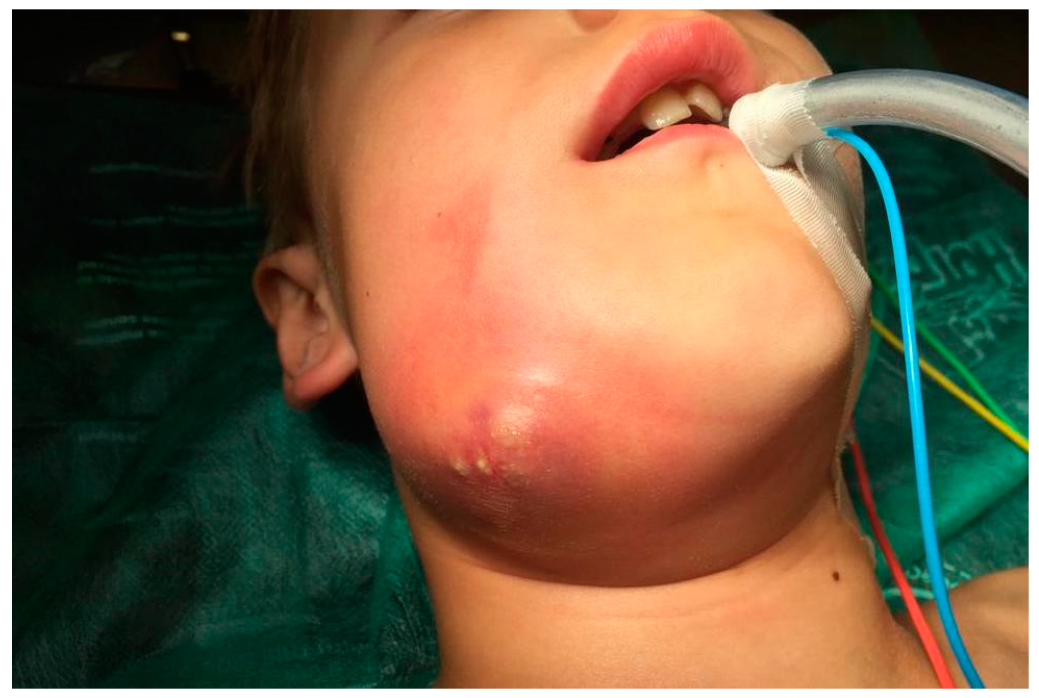 Facial cellulitis store