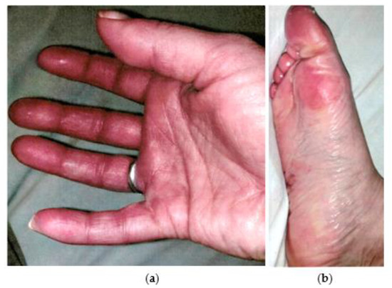 A Case of Autoimmune Small Fiber Neuropathy as Possible Post COVID Sequelae