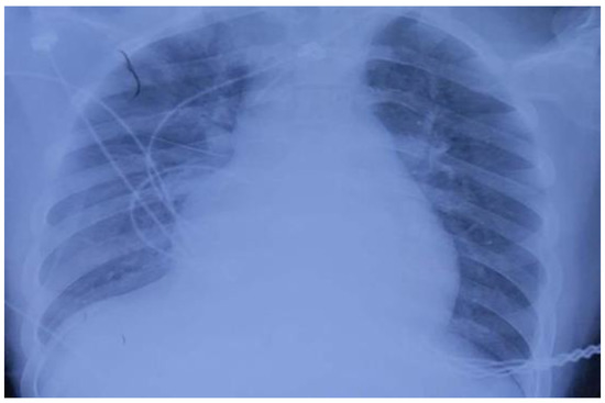 Case Report: Acute Intoxication from Phosphine Inhalation