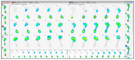 Characteristics of Pressure on the Apophysis in the Course of ...