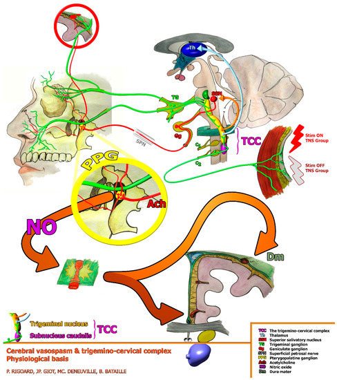 Evaluation of External Trigeminal Nerve Stimulation to Prevent Cerebral ...