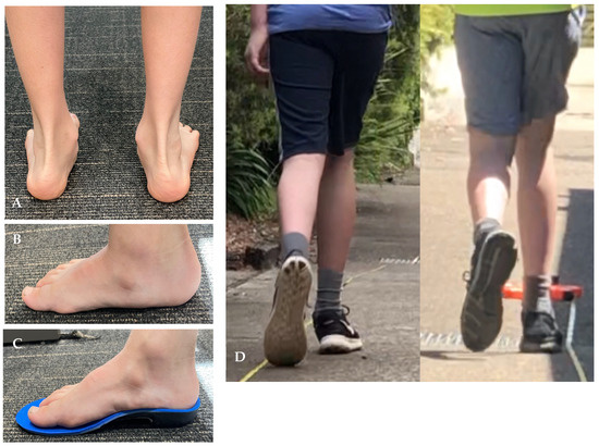 The Impact of Podiatric Intervention on the Quality of Life and Pain in ...