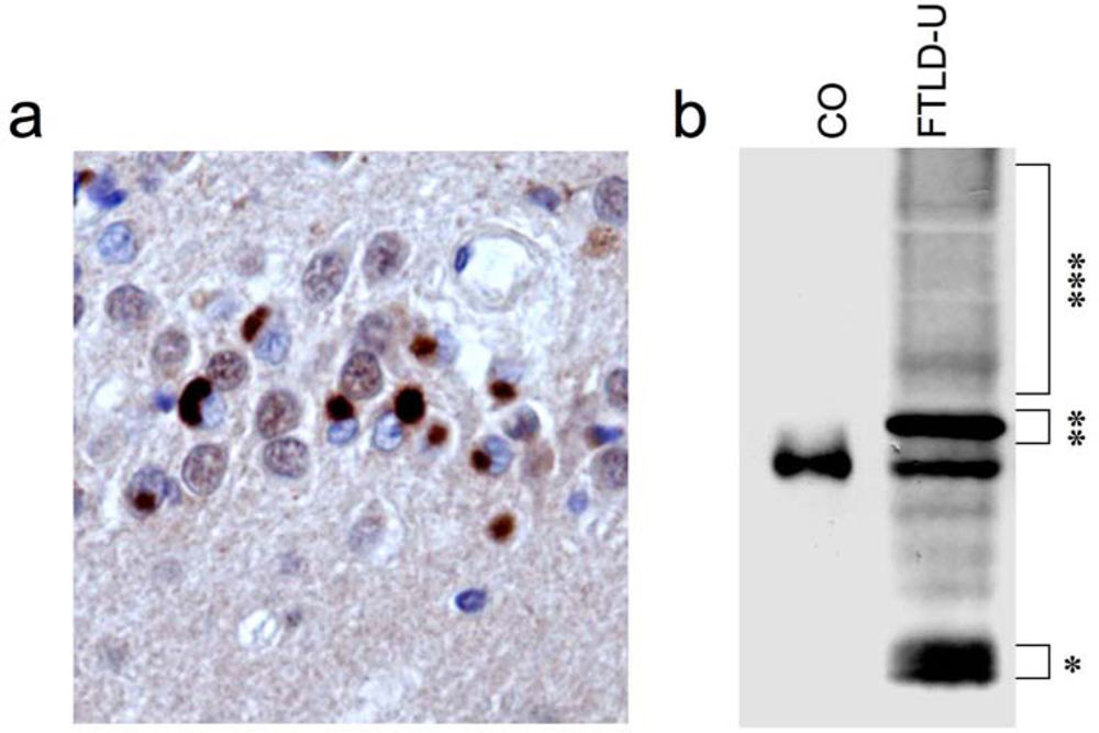 IJMS | Free Full-Text | Molecular Neuropathology of TDP-43 Proteinopathies
