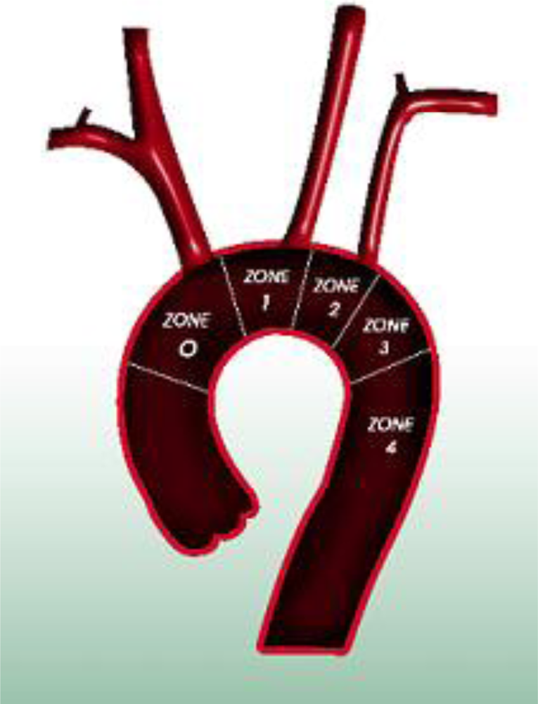 RETRACTED: Hybrid Endovascular Repair in Aortic Arch Pathologies: A ...