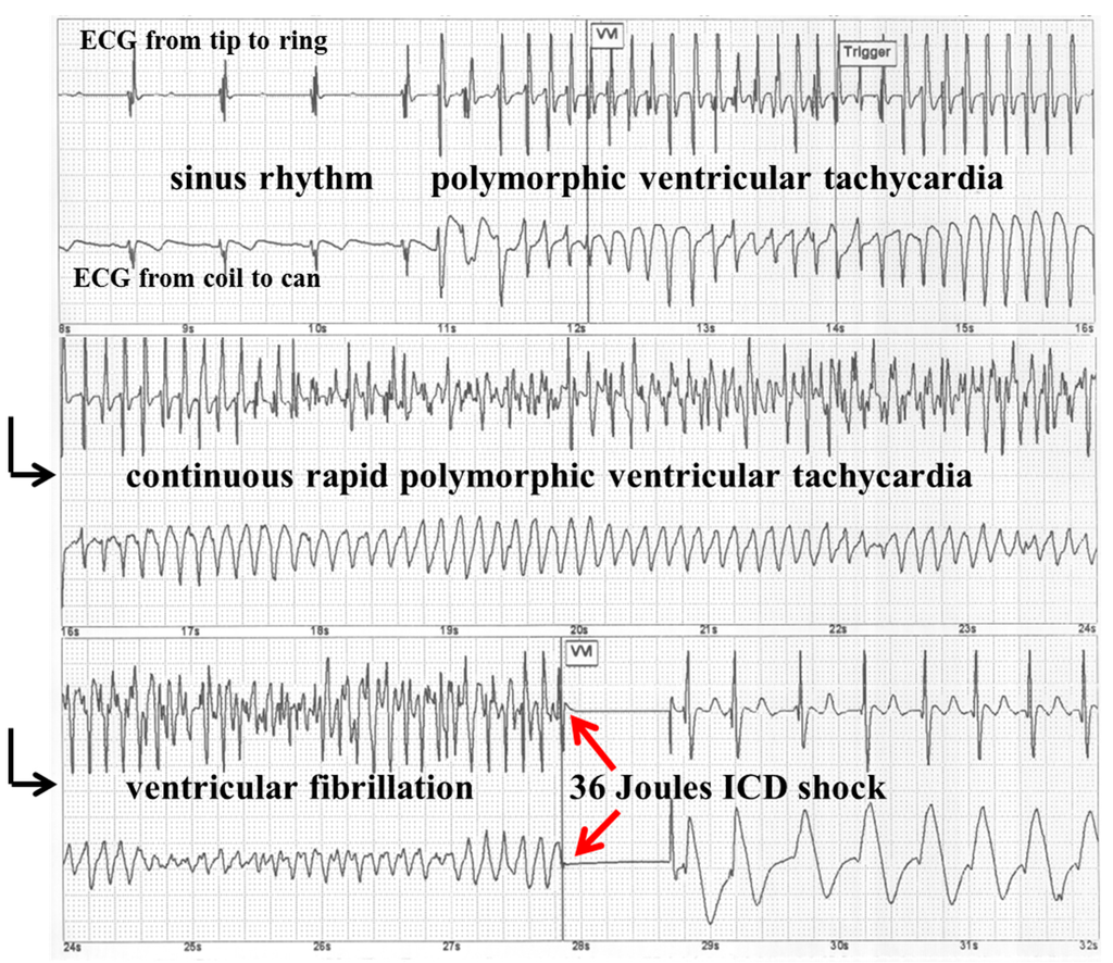 Cardiac Arrhythmias and Sleep-Disordered Breathing in Patients with Heart Failure
